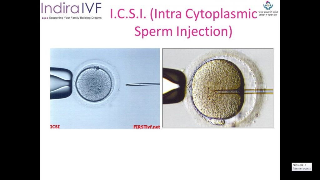 INTRA CYTOPLASMIC SPERM INJECTION (ICSI) - Dr. Amol Lunkad